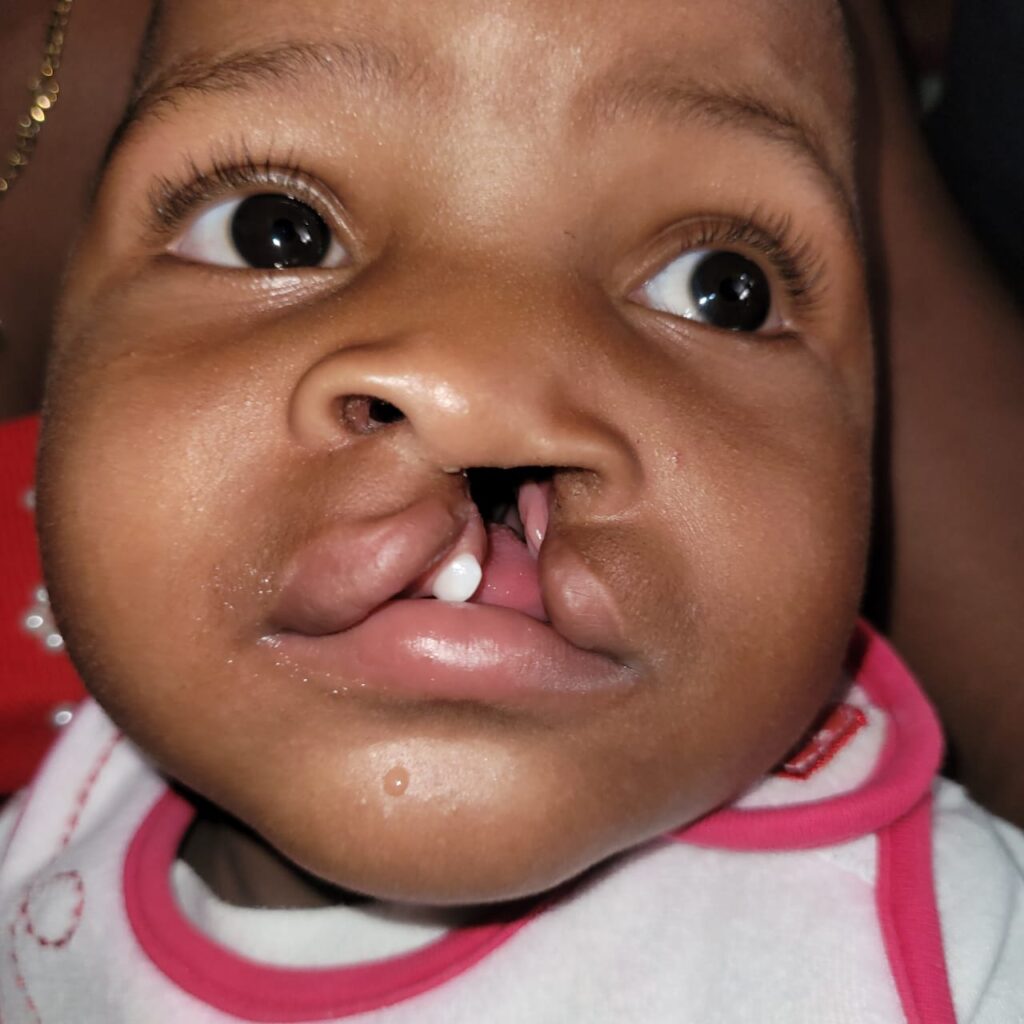 Inician la más grande Jornada de labios leporino y Paladar hendido ...